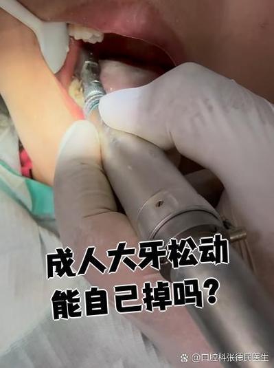 大牙松动要拔掉吗