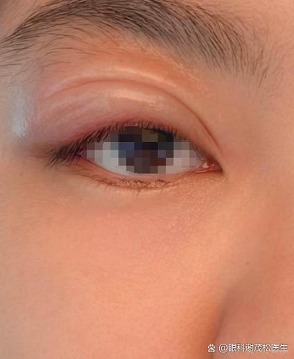 眼皮水肿是什么原因引起的图标