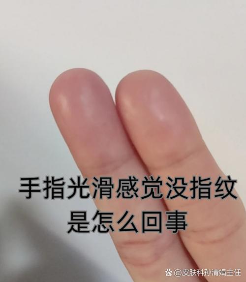 手指变光滑指纹消失了怎么办图标