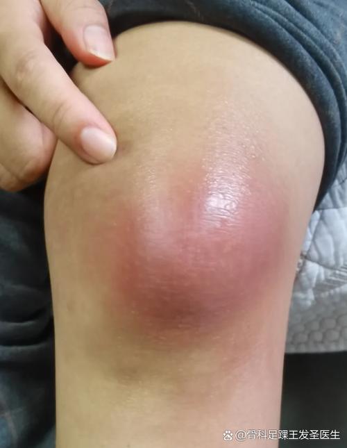 软组织肿胀能自愈吗图标