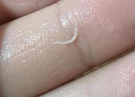 小孩有蛲虫会不会自愈