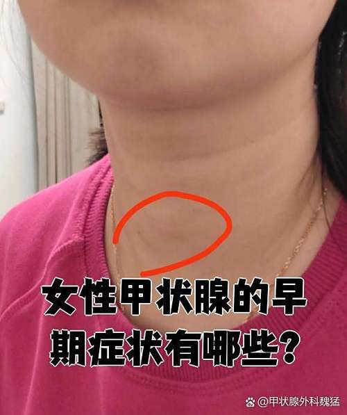 女性甲状腺的早期症状图片图标