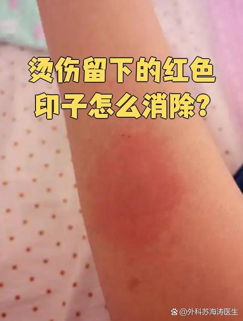 烫伤后红色印子怎么办图标