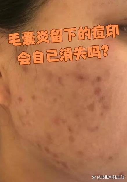 痘印能自己慢慢淡化吗图标