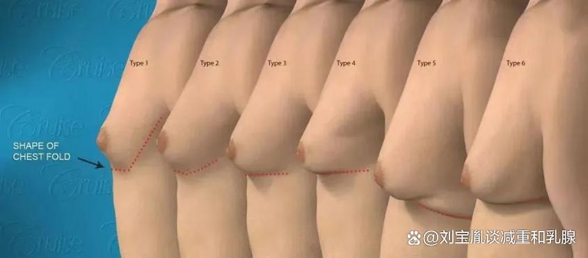乳房形状有哪些?图标