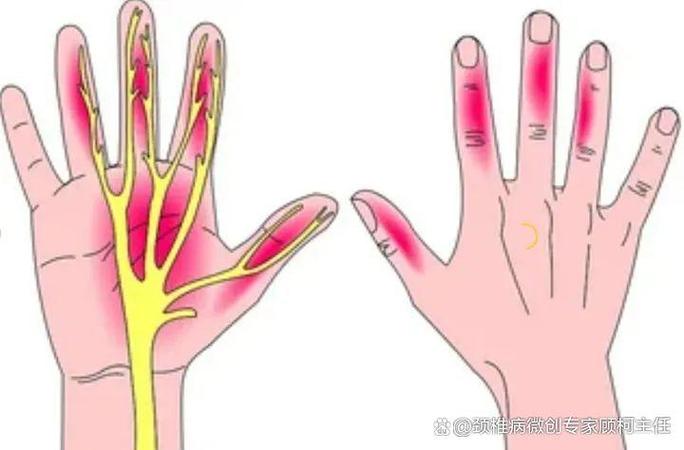手指发麻象触电一样是什么病