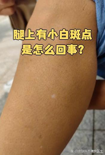 正常白斑图标