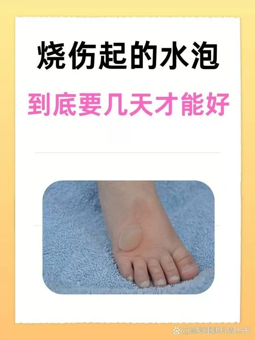 烫伤水泡可以自愈吗图标