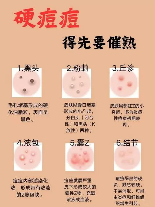 男朋友说长痘痘了该怎么回答截图