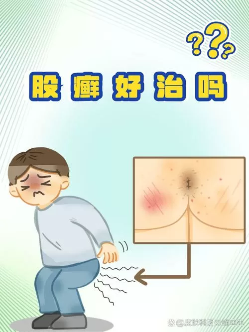 屁股痒的解决方法