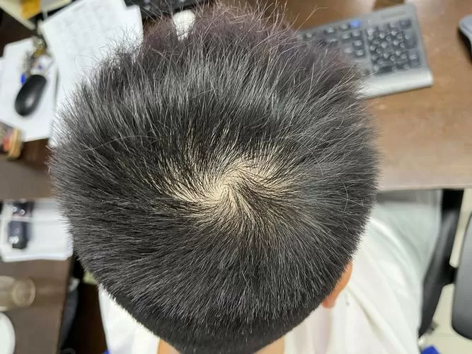 16岁头发漩涡处头发稀少秃顶图标