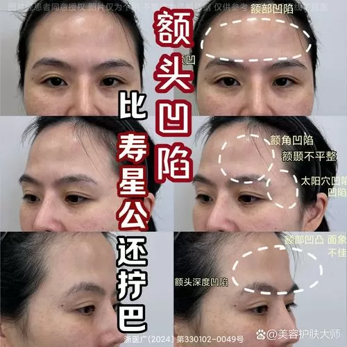 额头当中有凹陷截图