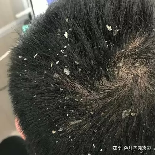 头上有白色一块一块的怎么办图标