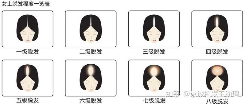 分发线秃了怎么办