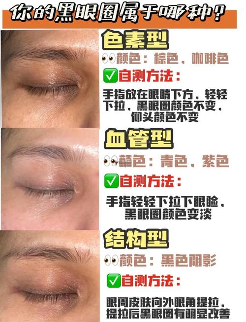 测试黑眼圈类型的
