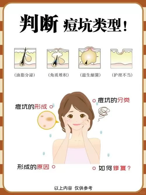 痘坑的形成原因图标