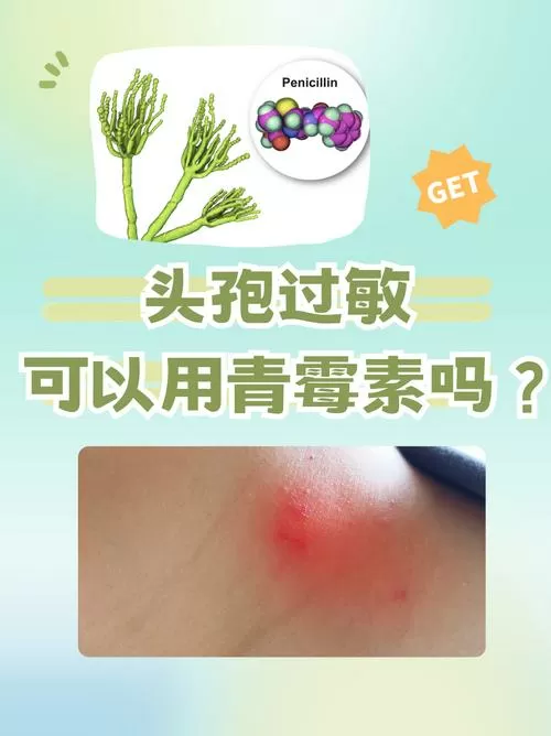 青霉素过敏是不是很麻烦呀截图
