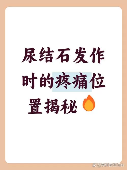 男子漏尿多年查出三处大结石图标