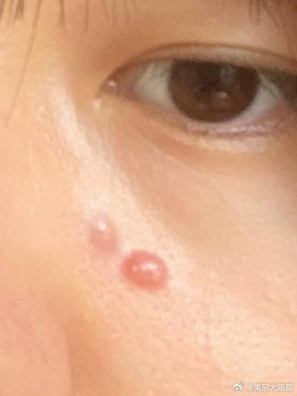 脸上起了红包一直不消图标