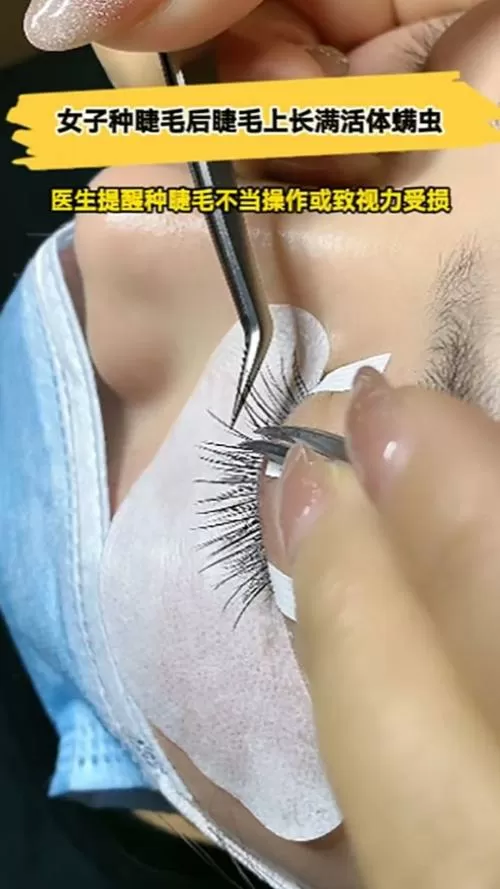 女子美睫后睫毛上长满螨虫