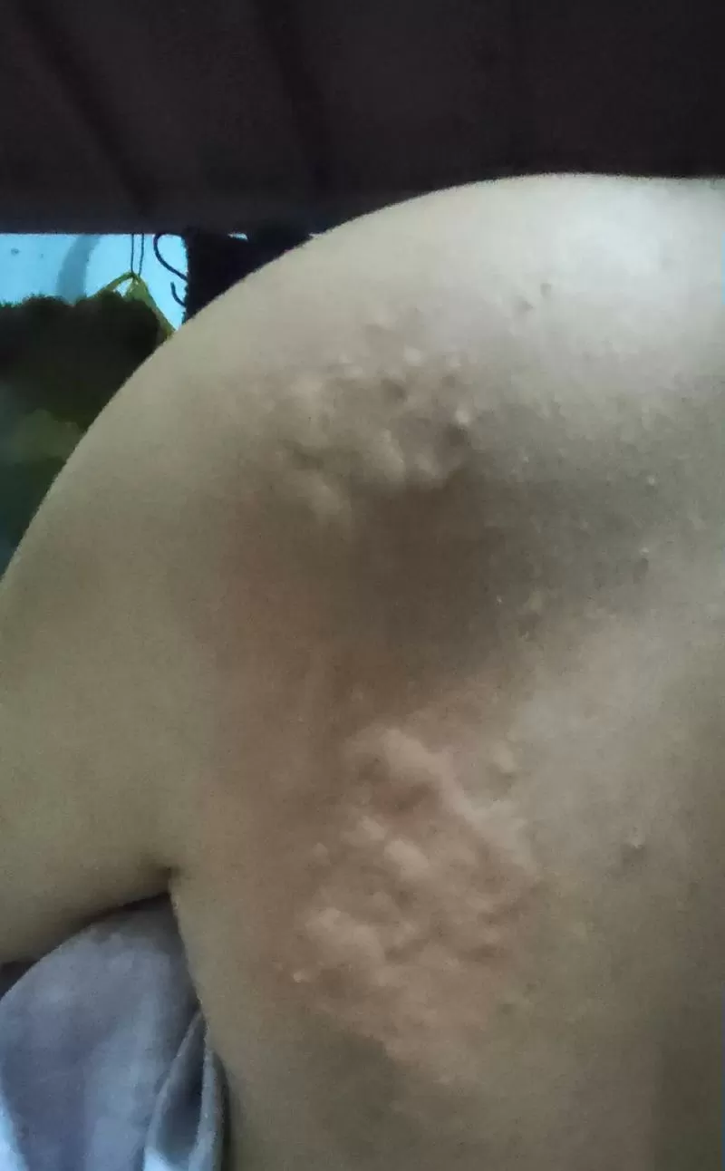皮肤干痒抓后起包包截图