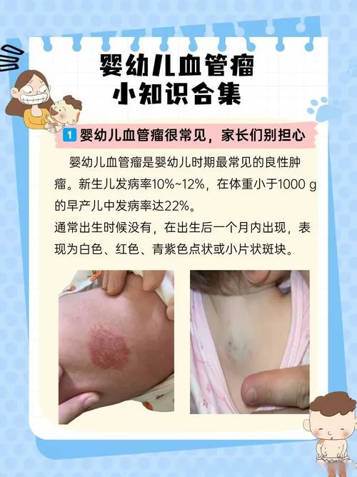 婴儿长血管瘤是什么原因引起的截图