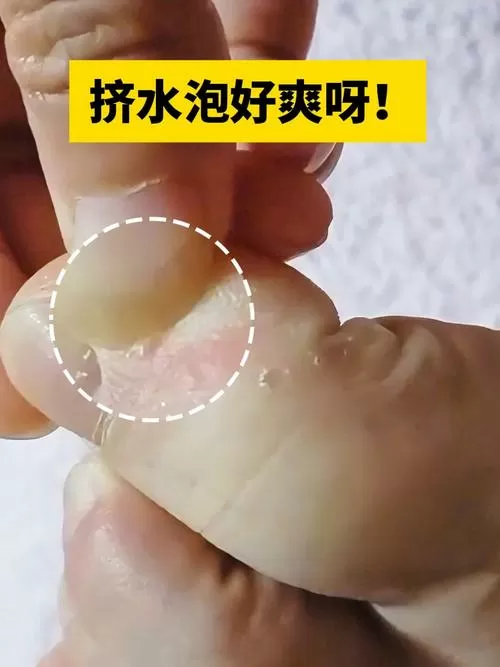 水泡挤了又鼓起来要挤吗截图