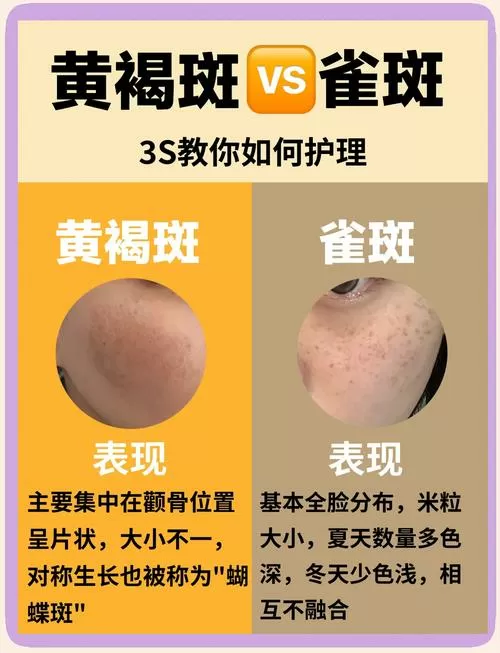 黄褐斑和雀斑的区别图图标